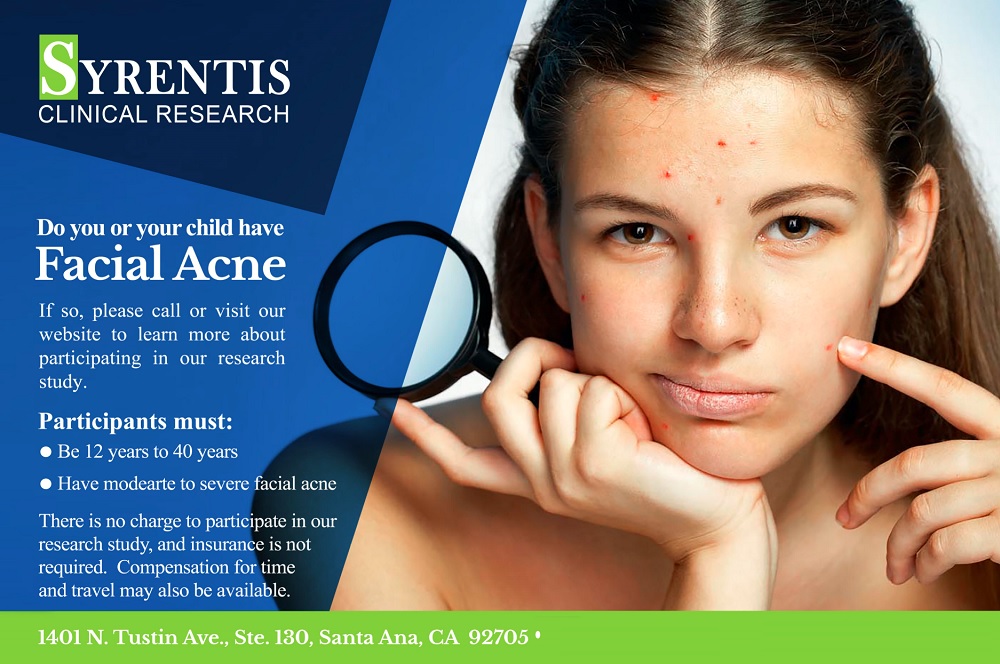 Acne - Santa Ana CA (Clinical Trial # 39820)
